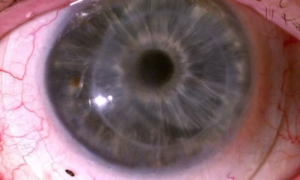 Have An Air Bubble Under Your Scleral Lens? Read These Tips To Avoid ...
